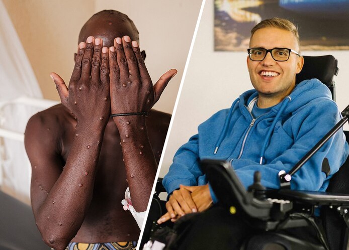 Nieuws gemist? Besmettelijk mpox-virus in Europa • Zieke Stephan (35 ...